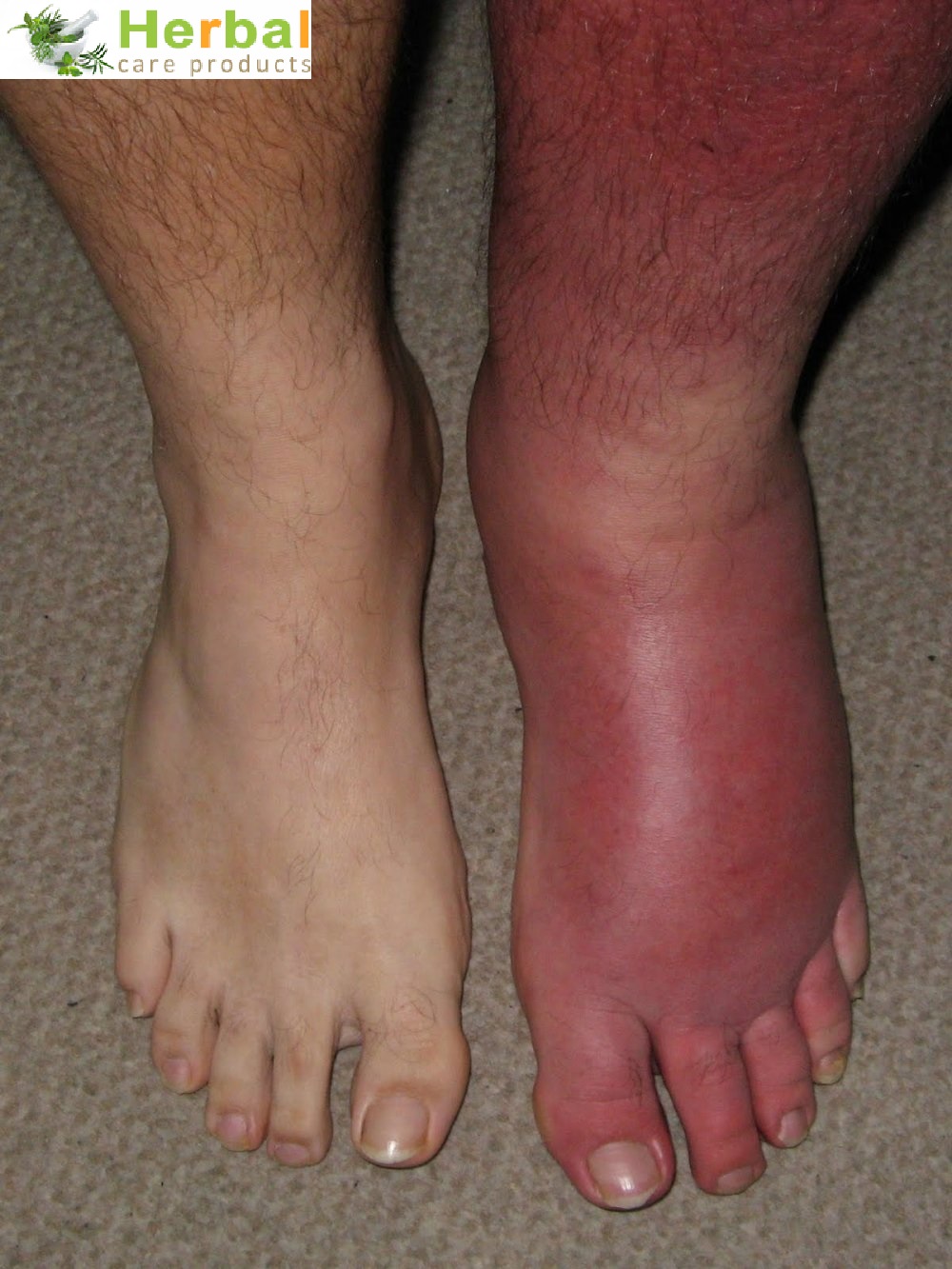 Cellulitis Pictures Symptoms Treatment Complications