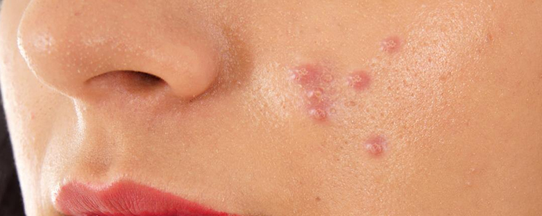 What causes Acne or Pimpl | Kayawell