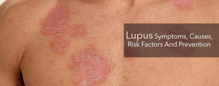 Lupus- Symptoms, Causes, Risk Factors and Prevention