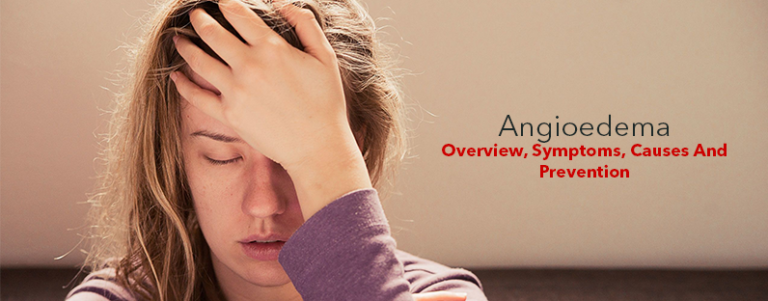 Angioedema- Overview, Symptoms, Causes and Prevention