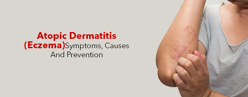 Atopic Dermatitis (Eczema) - Symptoms, Causes and Prevention | KayaWell