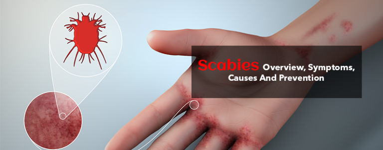Scabies- overview, symptoms, causes and prevention