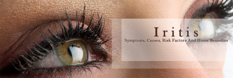 Iritis-Symptoms, Causes, Risk Factors and Home Remedies | Kayawell