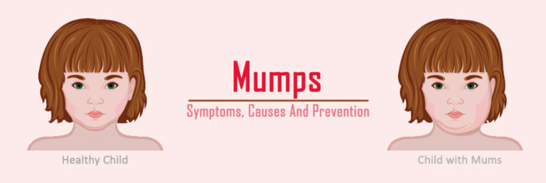 Mumps- Symptoms, Causes and Prevention