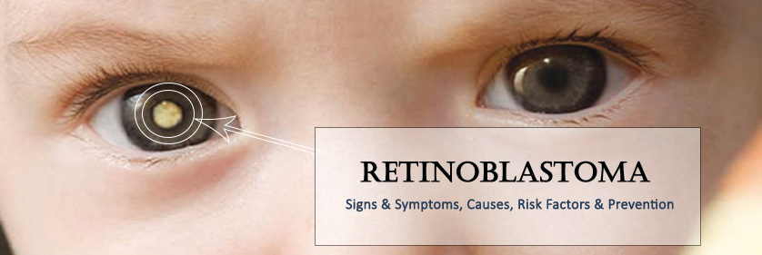 Retinoblastoma - Signs & Symptoms, Causes, Risk Factors and Prevention ...