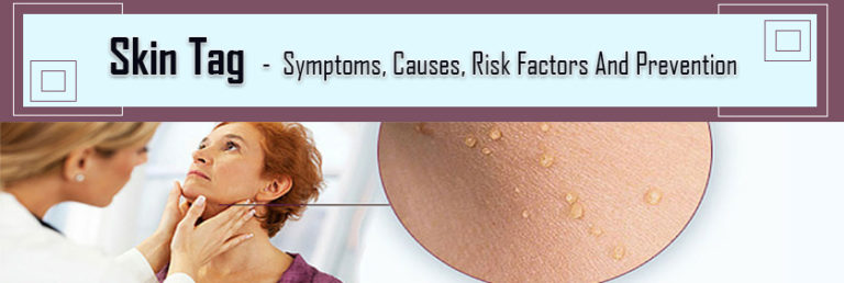 Skin Tag- Symptoms, Causes, Risk Factors and Prevention | Kayawell