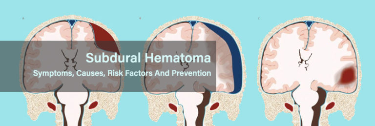 Subdural Hematoma- Symptoms, Causes, Risk Factors and Prevention