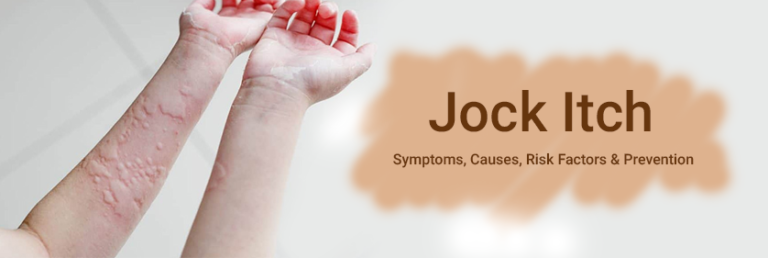 Jock Itch- Symptoms, Causes, Risk Factors and Prevention