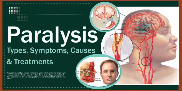 Paralysis Types, Symptoms, Causes & Treatments